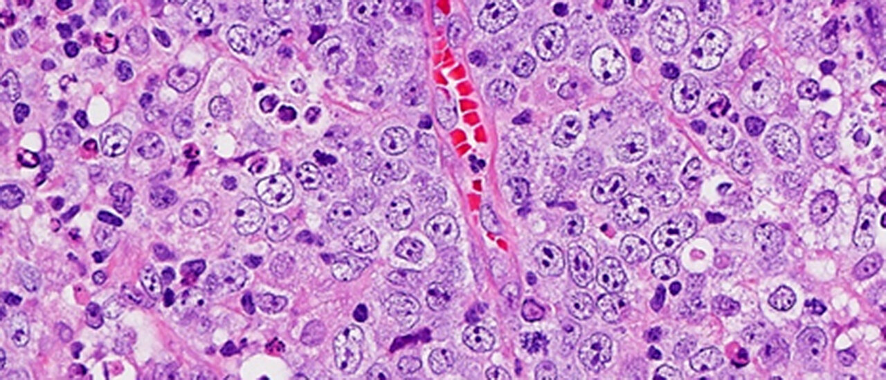 Lymphome: Forschung an einem Test für eine bessere Therapie ...